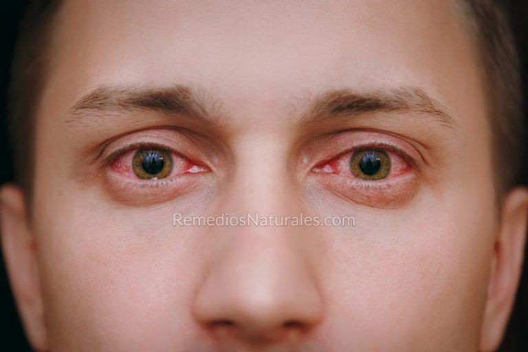 Conjuntivitis Alérgica Irritativa Y Bacteriana Síntomas Y