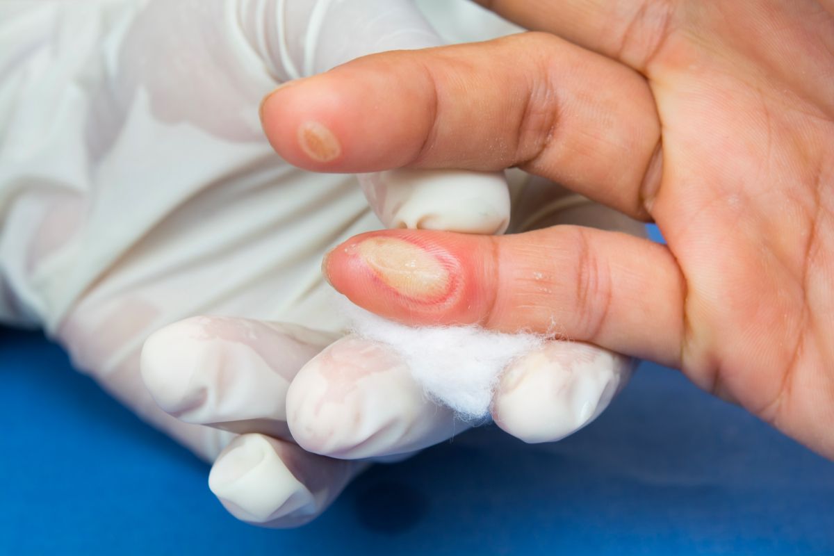 Ampollas: Síntomas, Causas, Evolución y Tratamiento – Remedios Naturales